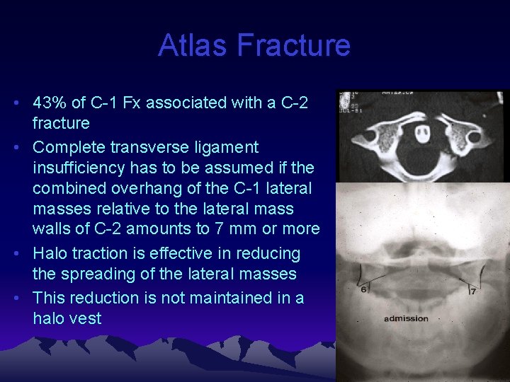 Basic Spine Fractures Naftaly Attias MD Orthopedic Department