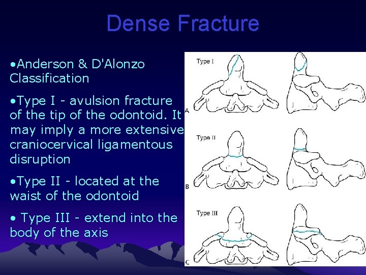 Basic Spine Fractures Naftaly Attias MD Orthopedic Department