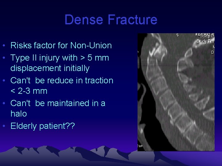 Basic Spine Fractures Naftaly Attias MD Orthopedic Department