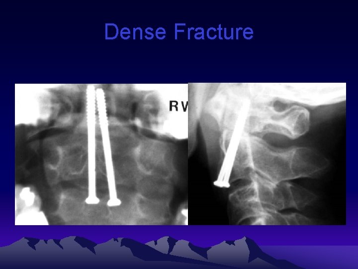 Basic Spine Fractures Naftaly Attias MD Orthopedic Department