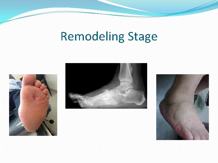 Assessing Charcot Foot in the Diabetic Patient with