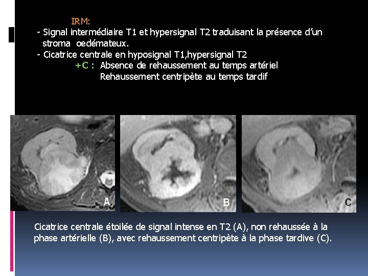 IMAGERIE DES TUMEURS RENALES Dr BOUTAKIOUTE Dr MRABTI