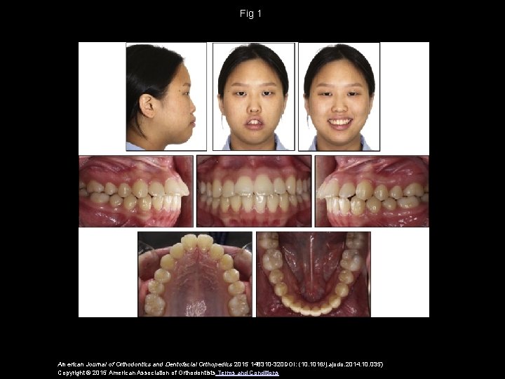 Correction of severe bimaxillary protrusion with first premolar