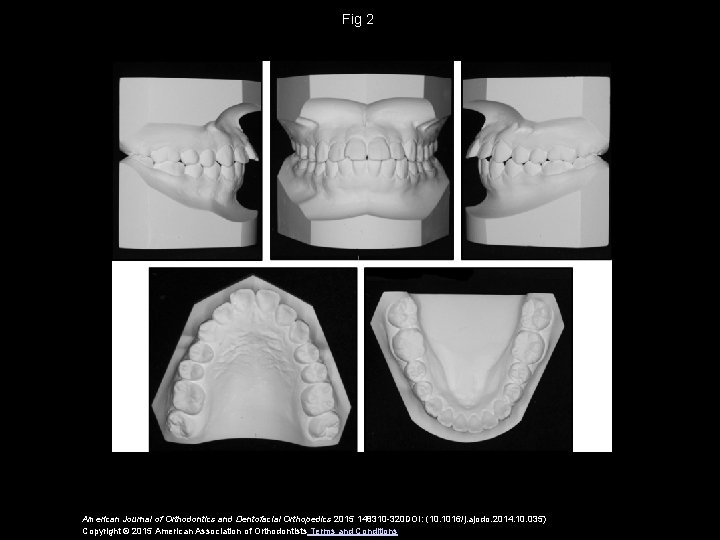 Correction of severe bimaxillary protrusion with first premolar