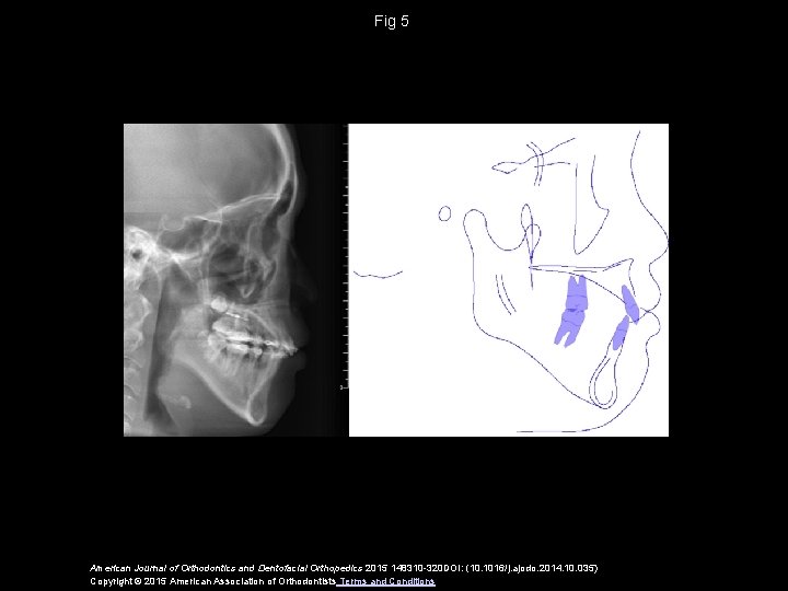Correction of severe bimaxillary protrusion with first premolar