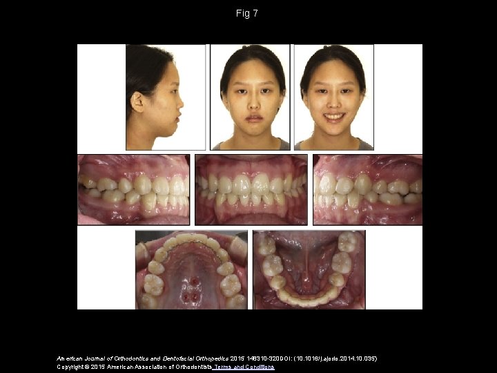 Correction of severe bimaxillary protrusion with first premolar