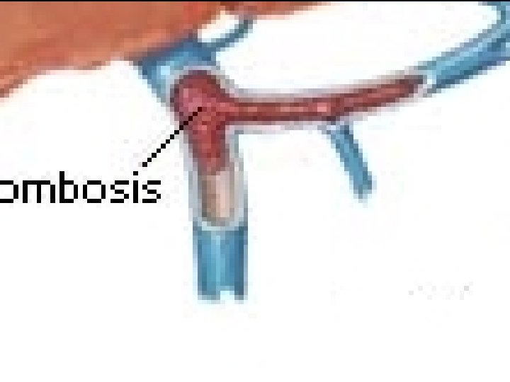 REX SHUNT TRATAMENTO CIRRGICO DA HIPERTENSO PORTAL COM