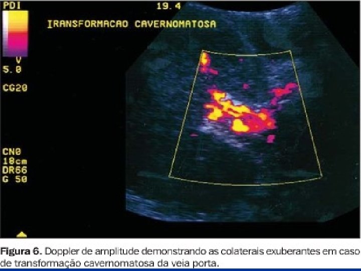 REX SHUNT TRATAMENTO CIRRGICO DA HIPERTENSO PORTAL COM