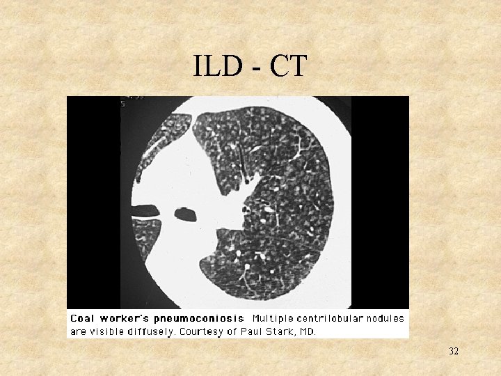 Occupational Lung Disease By John J Beneck MSPA