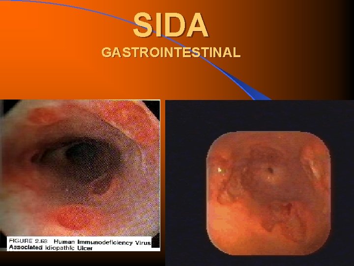 SIDA DR MARIO HERNANDEZ R SIDA GASTROINTESTINAL l