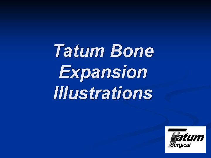 Tatum Bone Expansion Illustrations Indication for Bone Expansion