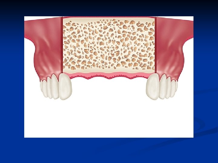 Tatum Bone Expansion Illustrations Indication for Bone Expansion