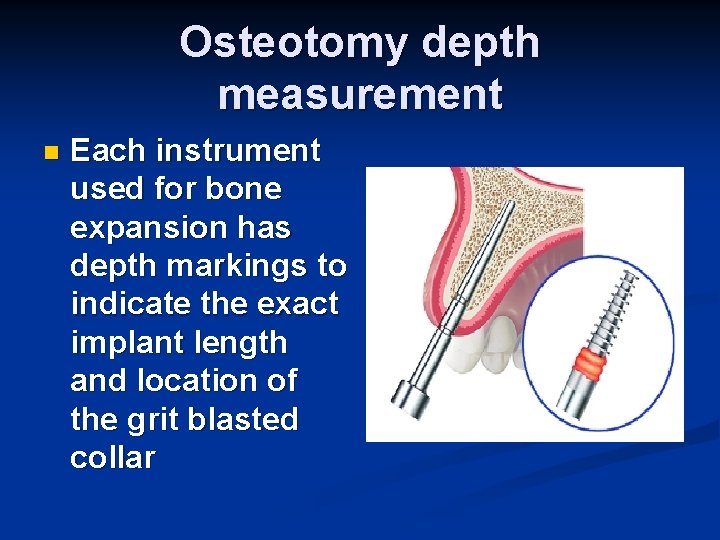 Tatum Bone Expansion Illustrations Indication for Bone Expansion