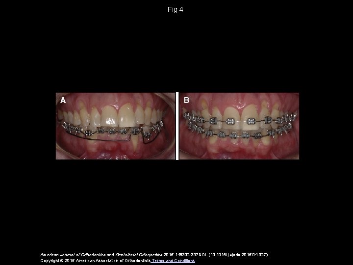 Orthodontic treatment of a mandibular incisor fenestration resulting