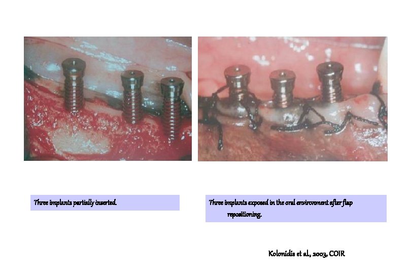 How to treat ailing and failing implants Roland