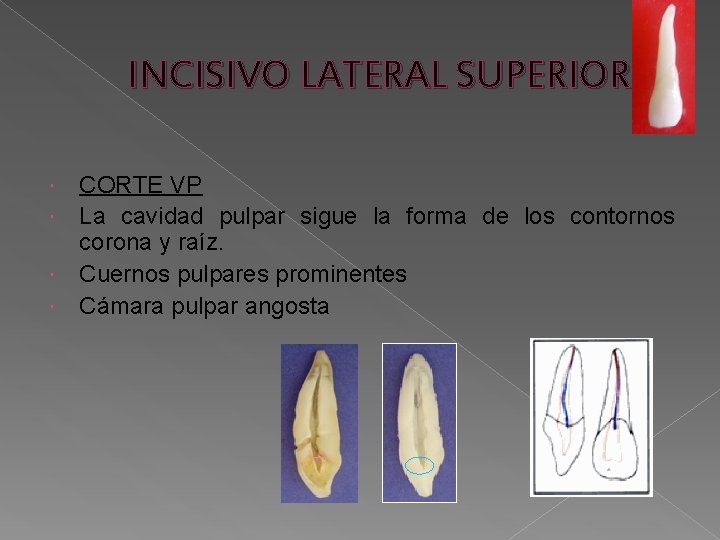 Cavidades pulpares en dientes permanentes ALEJANDRO LEON CARO