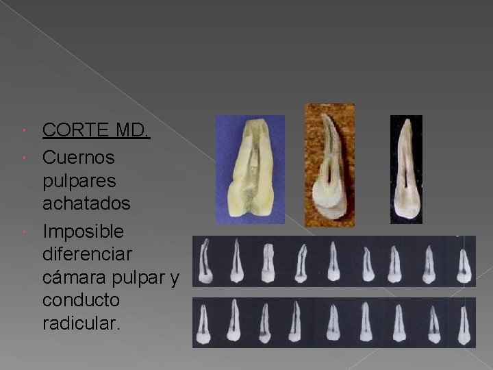 Cavidades pulpares en dientes permanentes ALEJANDRO LEON CARO