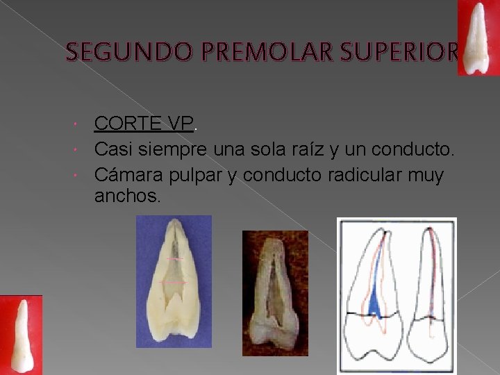 Cavidades pulpares en dientes permanentes ALEJANDRO LEON CARO