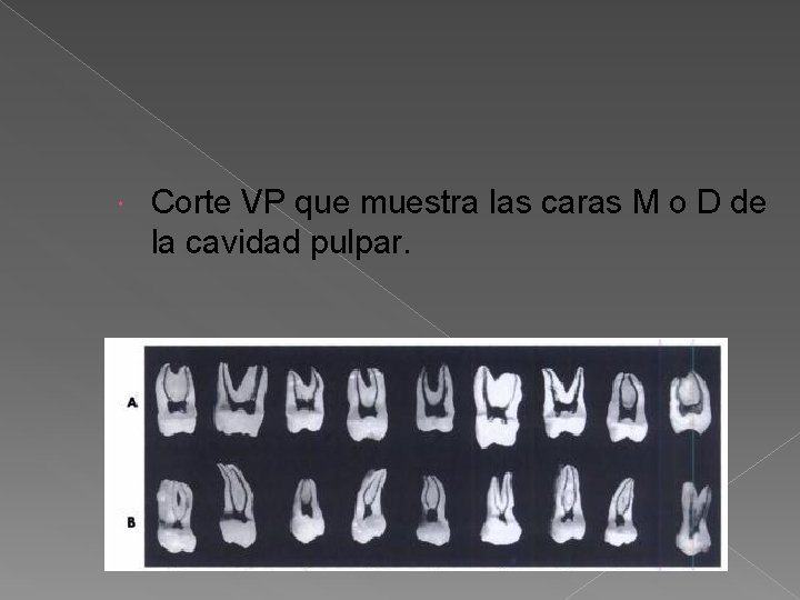 Cavidades pulpares en dientes permanentes ALEJANDRO LEON CARO
