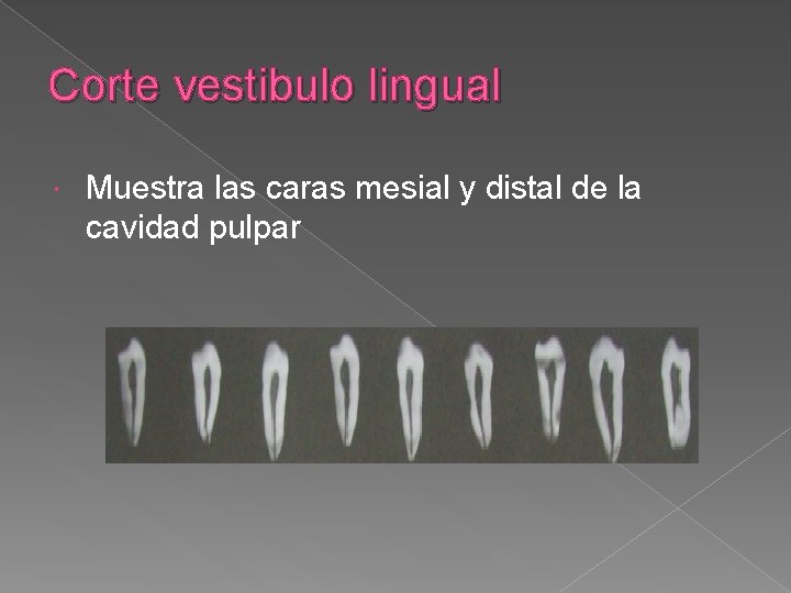 Cavidades pulpares en dientes permanentes ALEJANDRO LEON CARO