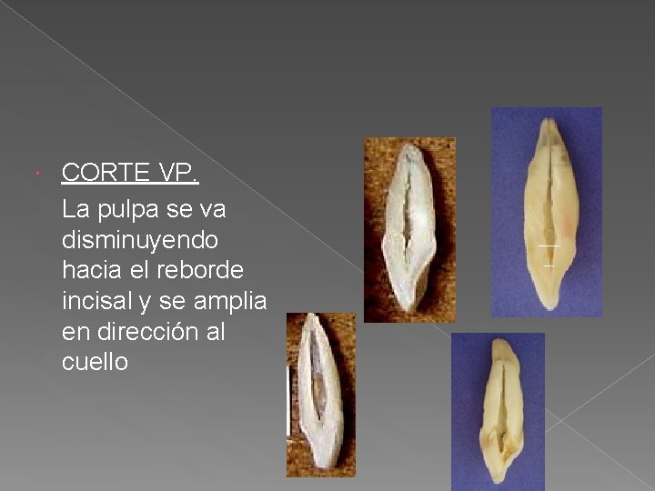 Cavidades pulpares en dientes permanentes ALEJANDRO LEON CARO
