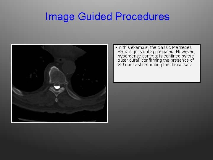 Iatrogenic Spinal Subdural Collections Lessons Learned ASNR 2015
