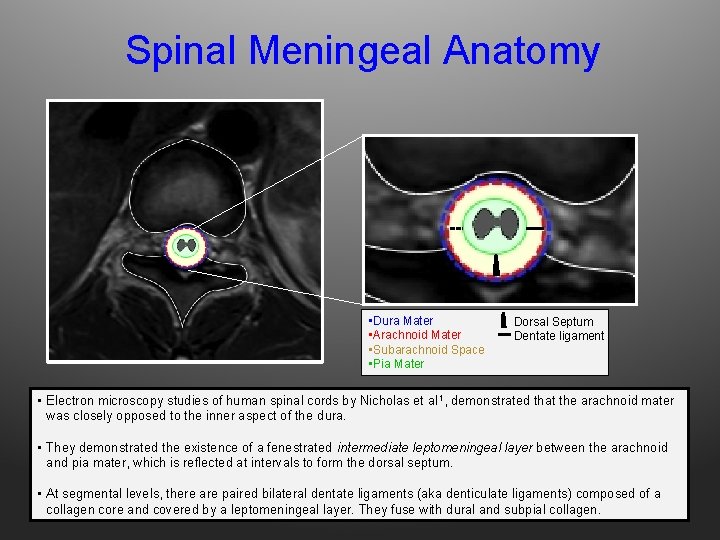 Iatrogenic Spinal Subdural Collections Lessons Learned ASNR 2015