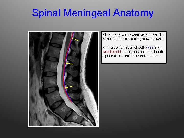 Iatrogenic Spinal Subdural Collections Lessons Learned ASNR 2015