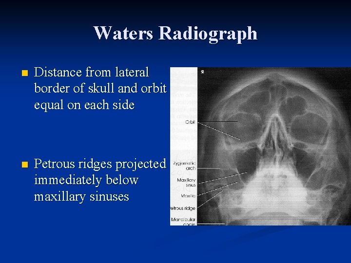 Facial Bone Anatomy Positioning RTEC 233 Anterior Aspect