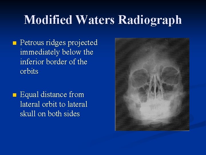 Facial Bone Anatomy Positioning RTEC 233 Anterior Aspect