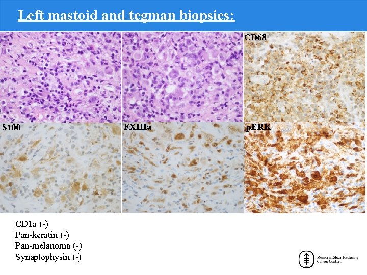 Oncogenic CLIP 2 BRAF Fusion is a Novel