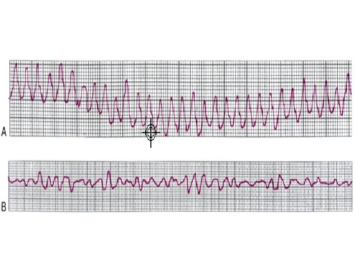 TAQUIARRITMIAS BRADIARRITMIAS ASISTOLIA TAQUIARRITMIAS QRS ANGOSTO ...