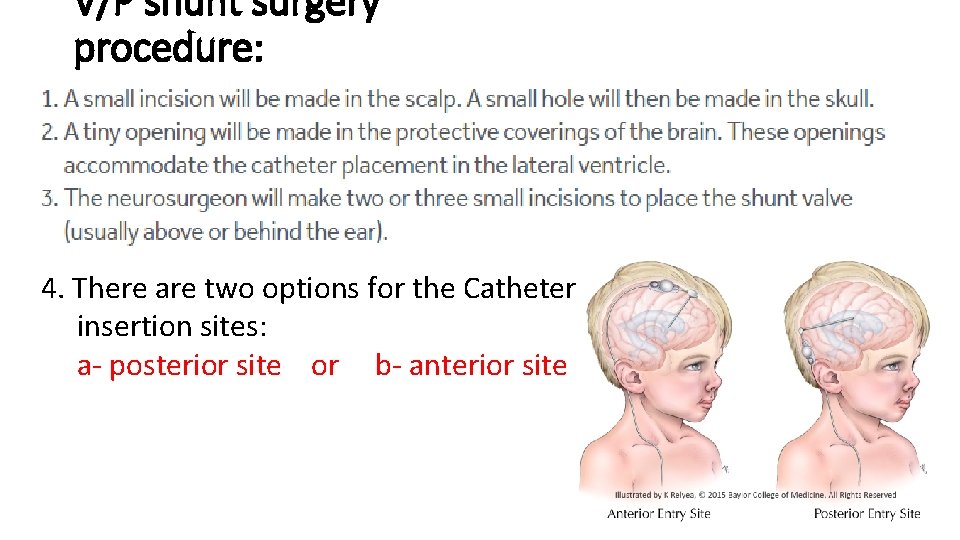 Possible implications of a VP shunt surgery on