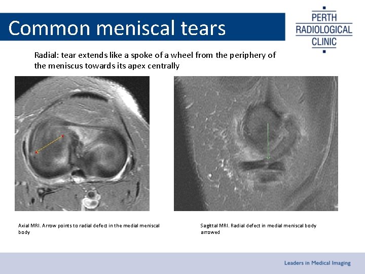 Common meniscal tears Buckethandle extensive vertical tearing with