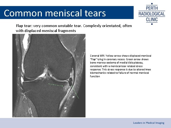 Common meniscal tears Buckethandle extensive vertical tearing with
