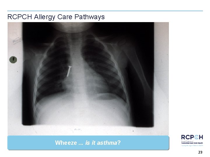 INTRODUCING FOUR RCPCH ALLERGY CARE SAMPLE TITLE PATHWAYS