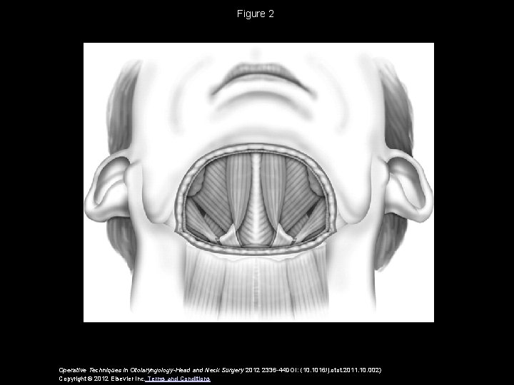 Conventional tongue base volumetric reduction for obstructive sleep