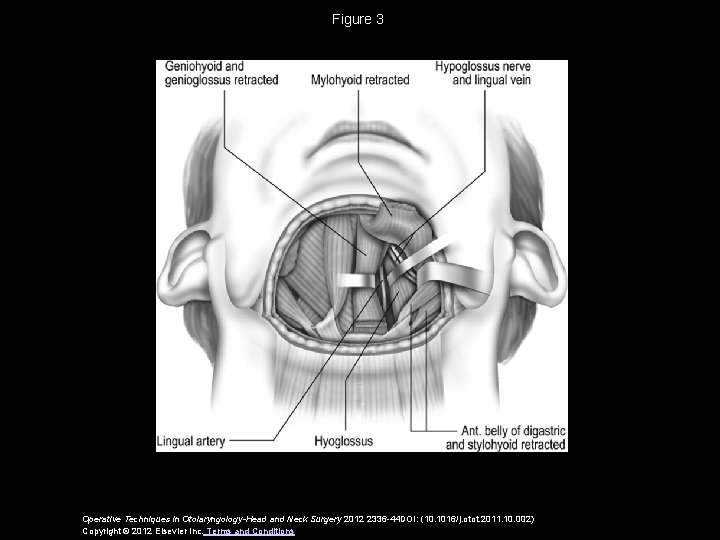 Conventional tongue base volumetric reduction for obstructive sleep