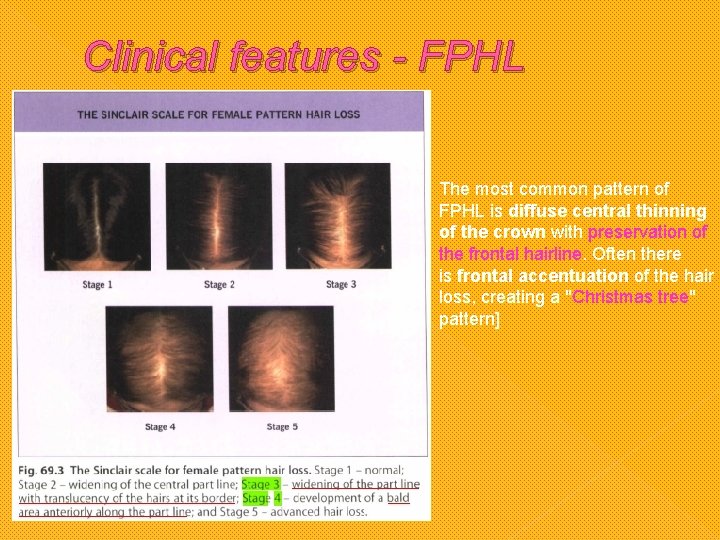 Androgenetic Alopecia Male and Female Pattern Hair Loss