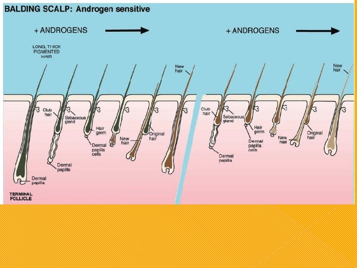 Androgenetic Alopecia Male and Female Pattern Hair Loss