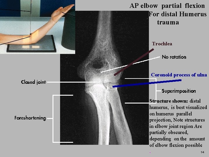 RAD 222 Upper extremity part 2 forearm elbow