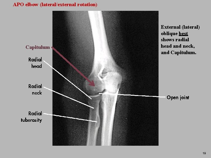 RAD 222 Upper extremity part 2 forearm elbow