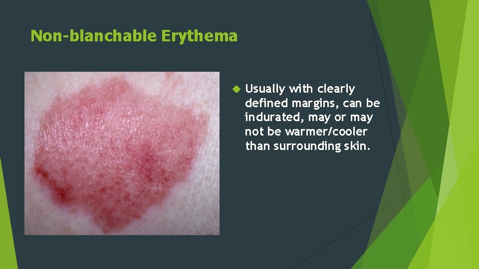 Pressure UlcersInjuries Assessment and Treatment Caryn Goolsby BSN