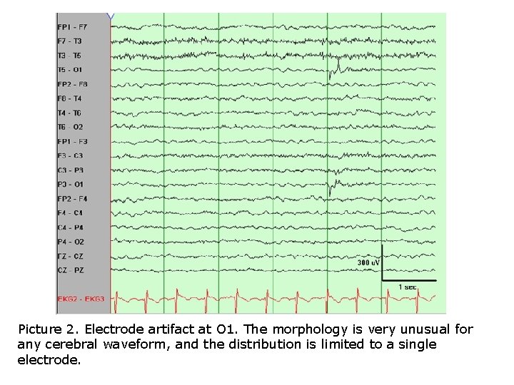 Picture 2 Electrode artifact at O 1 The