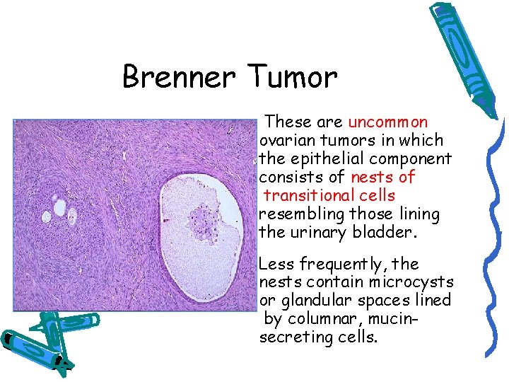 Ovarian Tumors Epidemiology Ranks below only carcinoma of