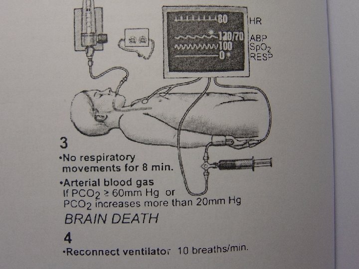 End of life care Brain death Declaration Process
