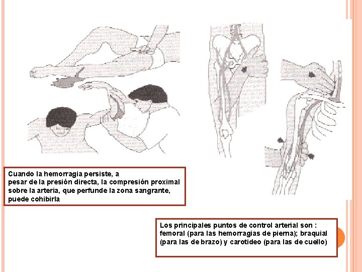 TCNICAS PARA EL CONTROL DE HEMORRAGIA Y DE