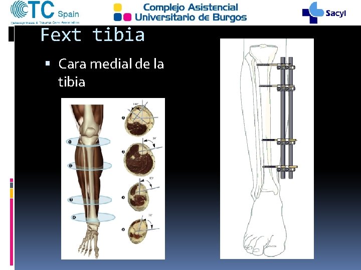 FIJACIN EXTERNA PROVISIONAL EN EL TRATAMIENTO SECUENCIAL DE