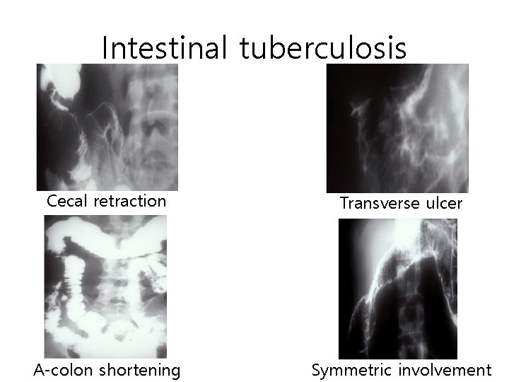 Radiologic Dx of GI Tract Dong Ho LEE