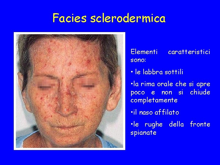 CONNETTIVITI Lupus eritematoso sistemico Sindrome da anticorpi ...